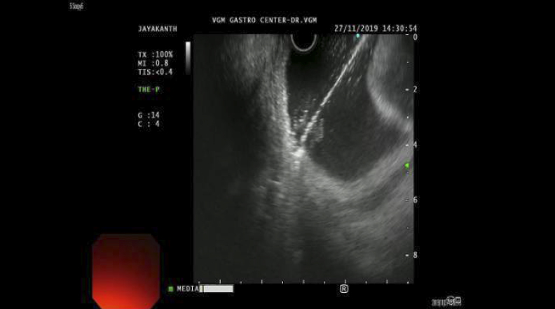 EUS Guided Cystogastrostomy