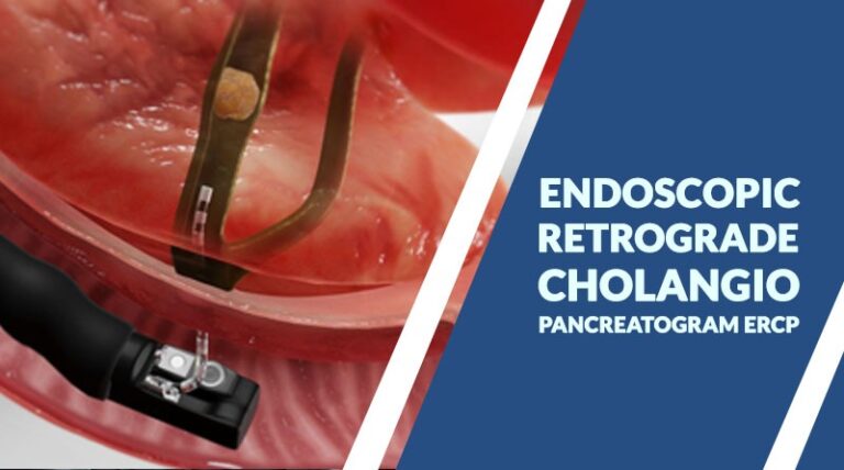 Endoscopic Retrograde Cholangio Pancreatogram (ERCP)