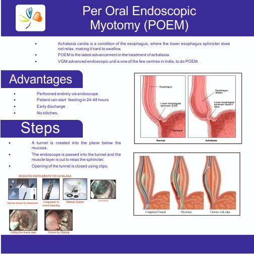 Per Oral Endoscopic Myotomy (POEM)