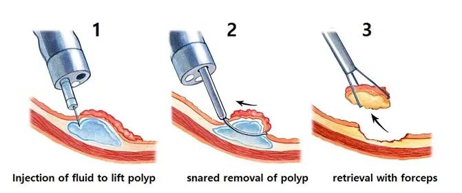 Barrett s Esophagus Causes And Effective Treatments Barrett s Esophagus Causes And Effective Treatments